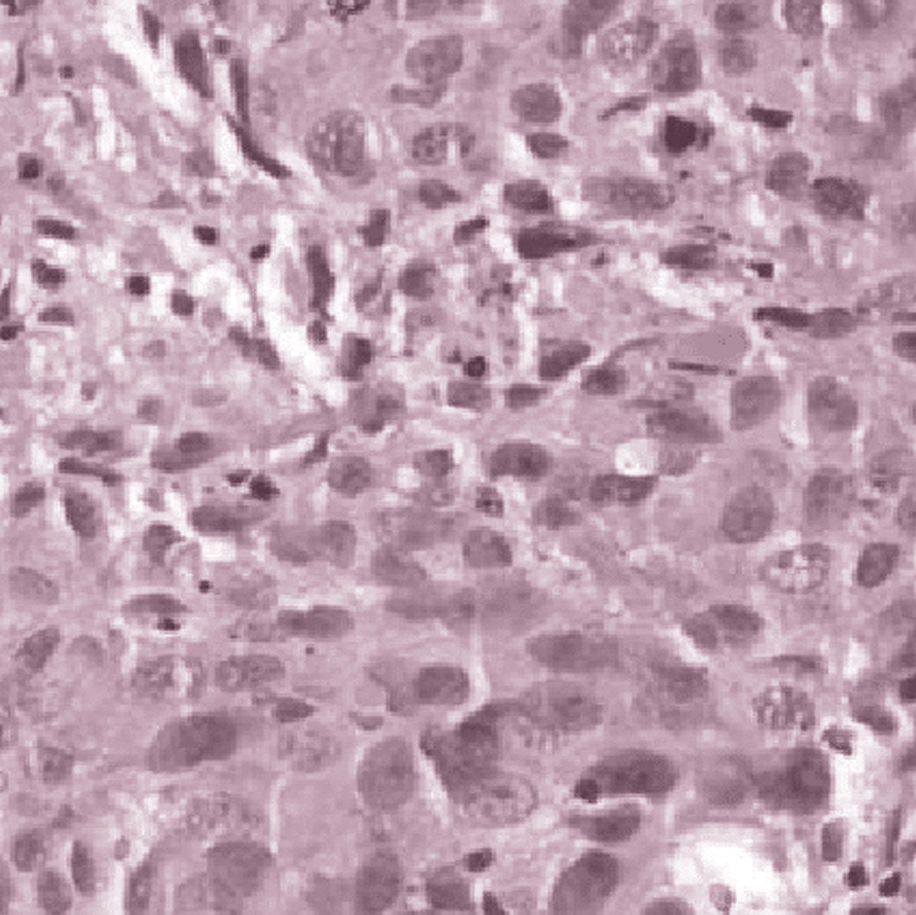 An Overview of Invasive Ductal Carcinoma